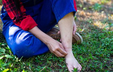 How To Treat Chigger Bites - Chiggerex